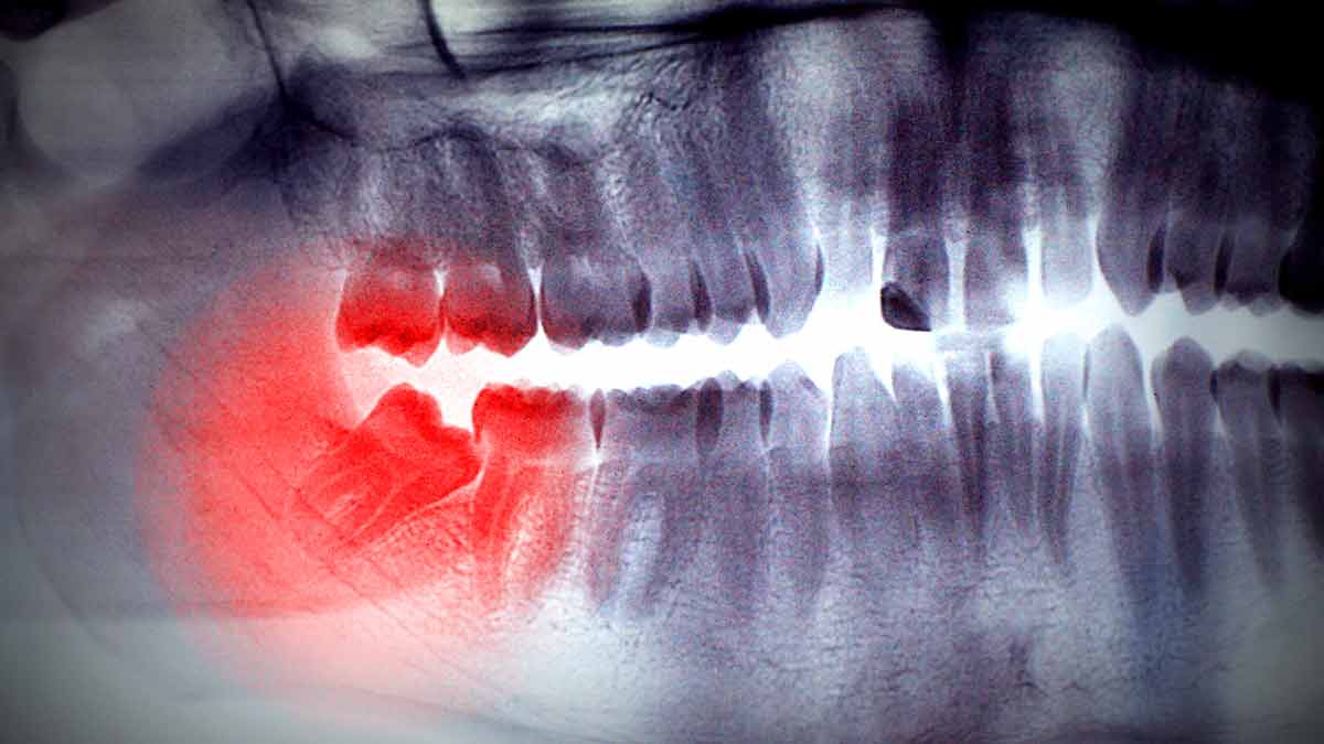 Wisdom Teeth Removal & Costs | Red Bud Dental